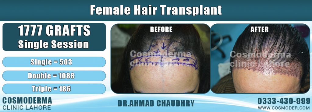 Female Hair Transplant In Lahore Pakistan Specialist Clinic Call Us