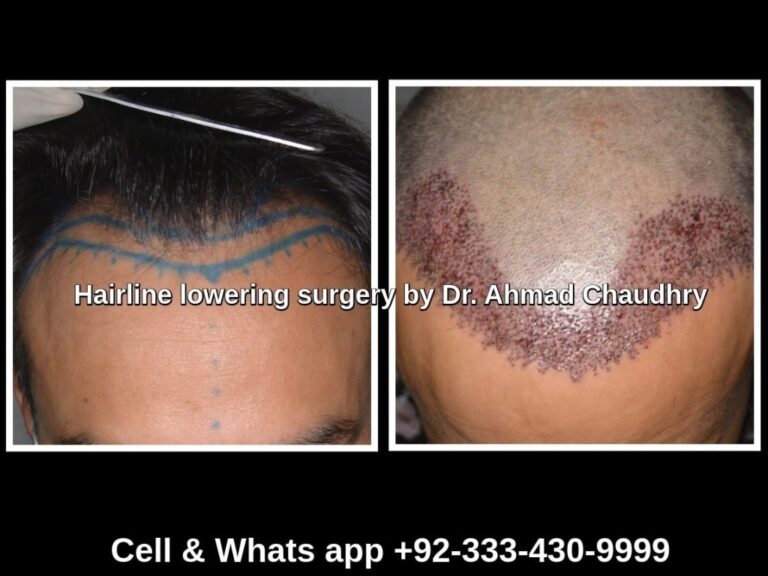 Hairline Lowering Surgery in male | Hair transplant clinic Lahore Pakistan