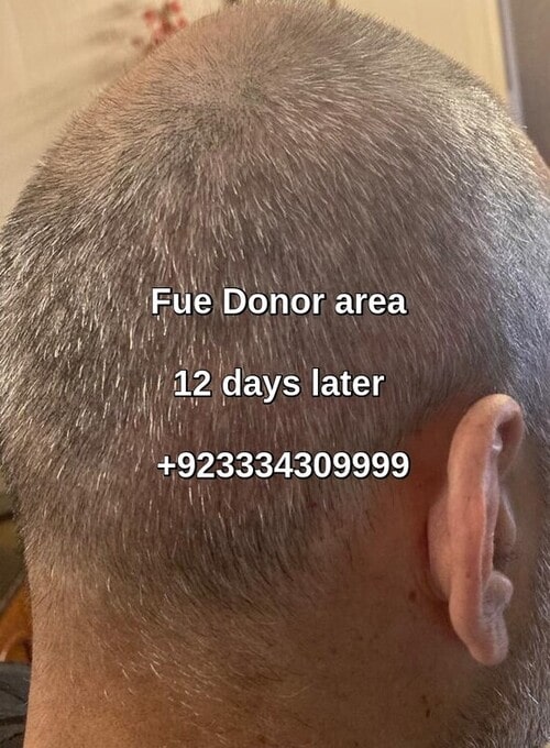 Fue Hair Transplant Donor Area Healing Hair Transplant Clinic Pakistan